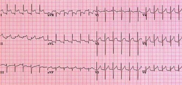 Pericardite Aguda – ANGOMED NEWS