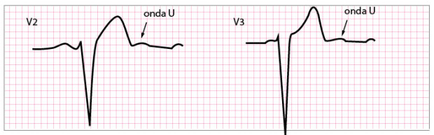 O electrocardiograma – ANGOMED NEWS